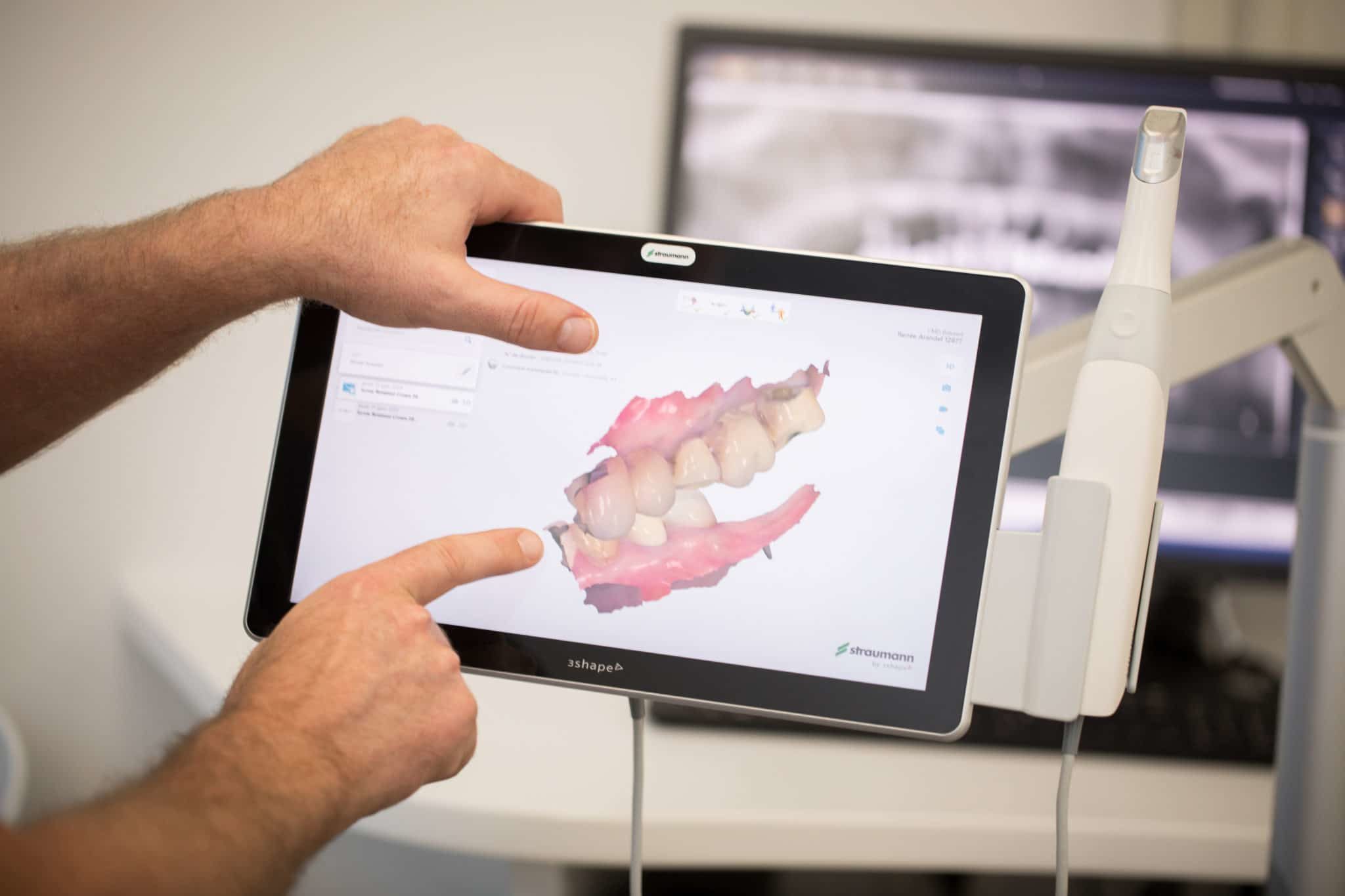 Empreinte Optique Dentaire - CMD Balexert